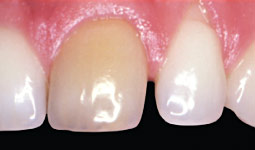 Internal Bleaching Houston TX, Endodontics Houston
